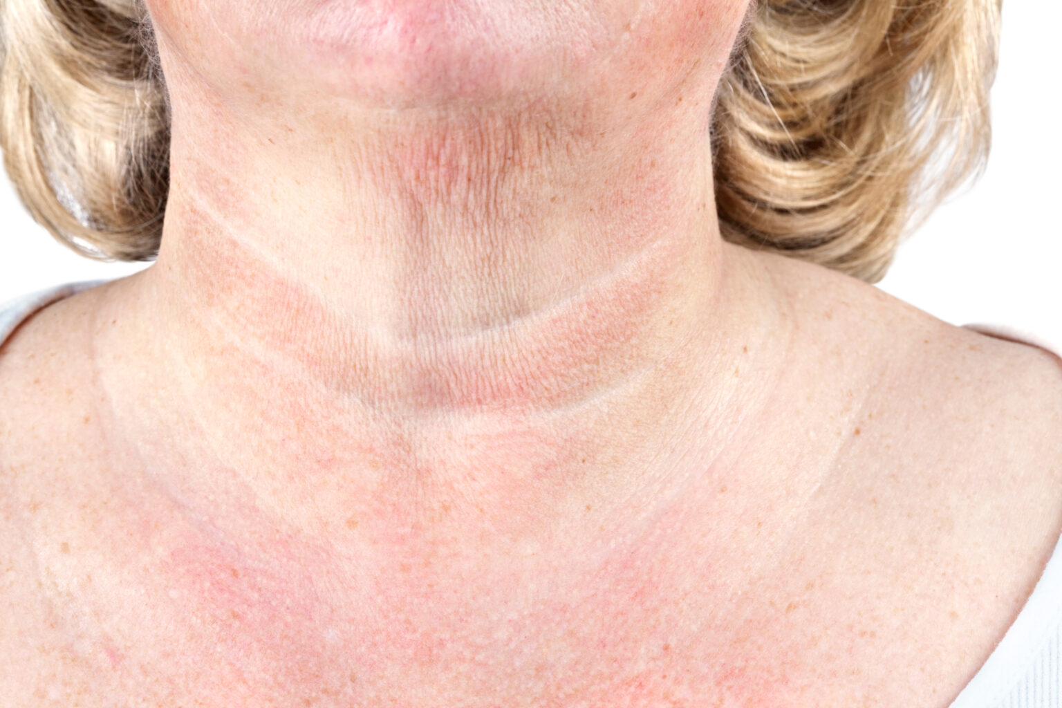 Neck Lines and Lift - Antcliff Facial Aesthetics of Bath