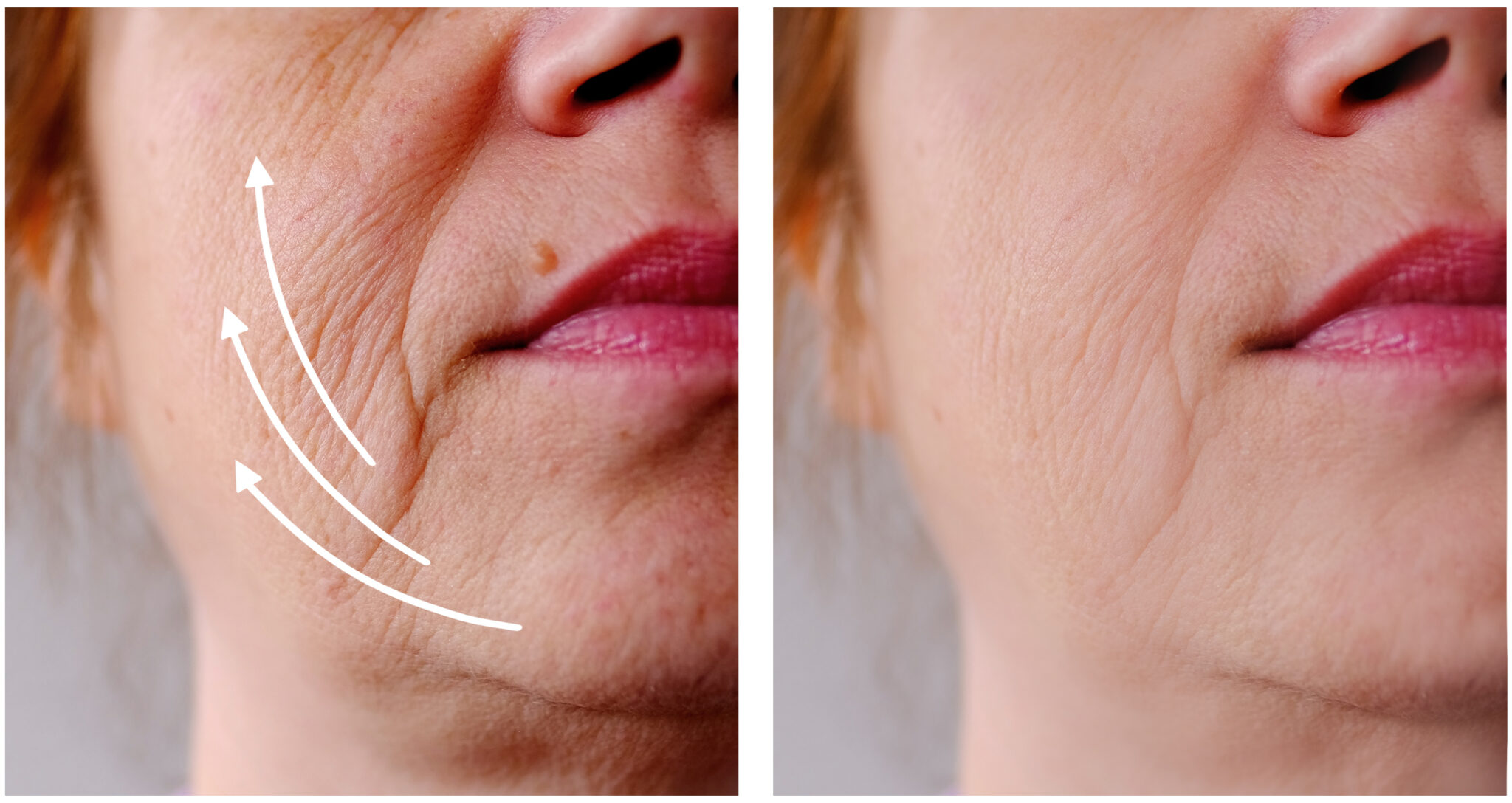 Crepey or Sagging Skin - Antcliff Facial Aesthetics of Bath